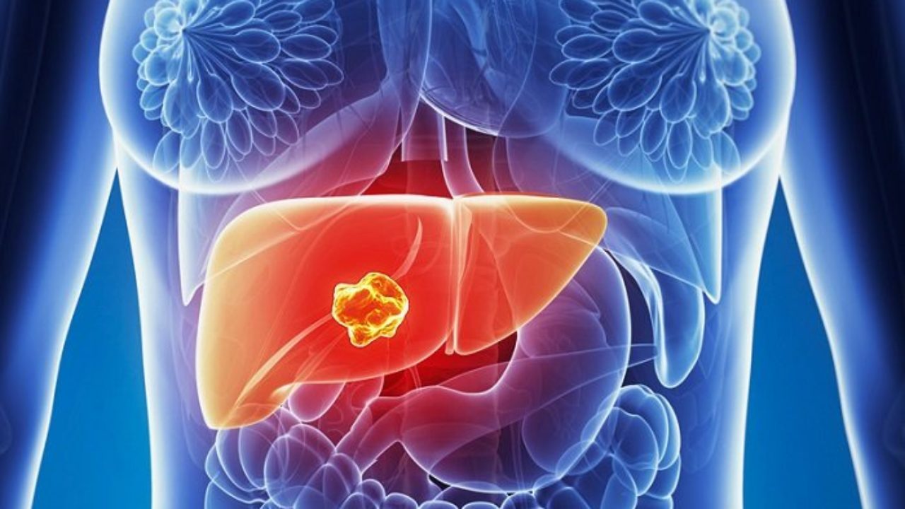 Cancro al fegato: tipi, cause, sintomi e prognosi Cancro al fegato: tipi, cause, sintomi e prognosi