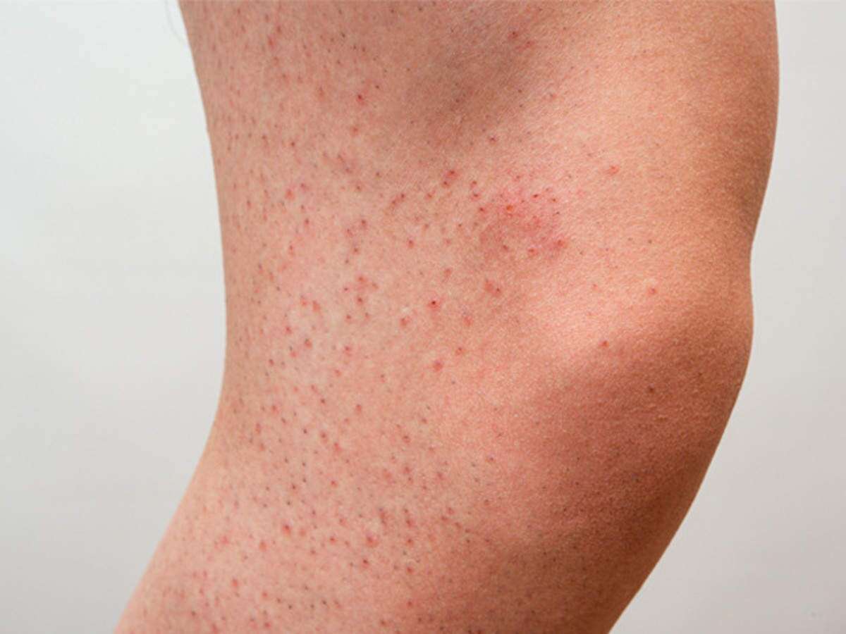 Puntini rossi sulle gambe, perché compaiono? Cosa sono? Puntini rossi sulle gambe, perché compaiono? Cosa sono?