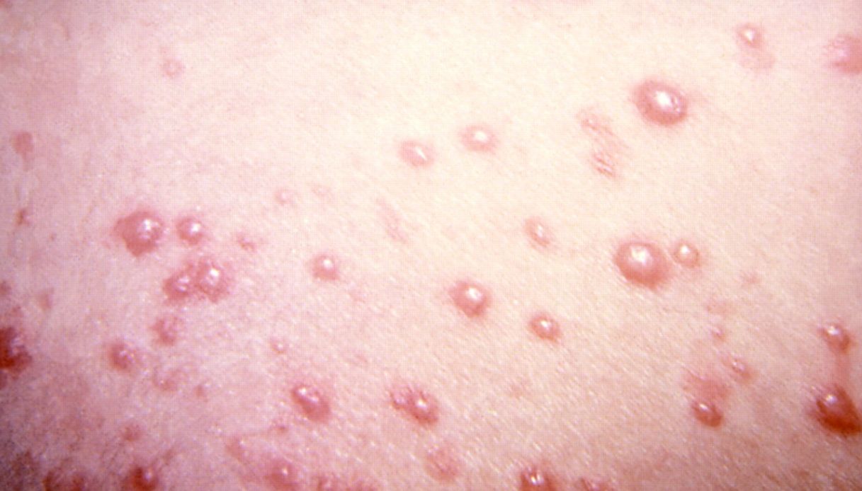 Fuoco di Sant'Antonio: quali sono i primi sintomi