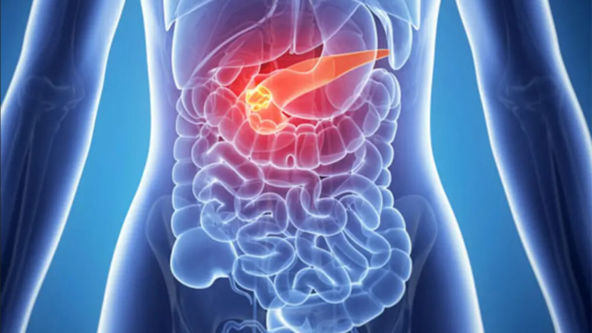 Tumore al pancreas: i sintomi da non sottovalutare