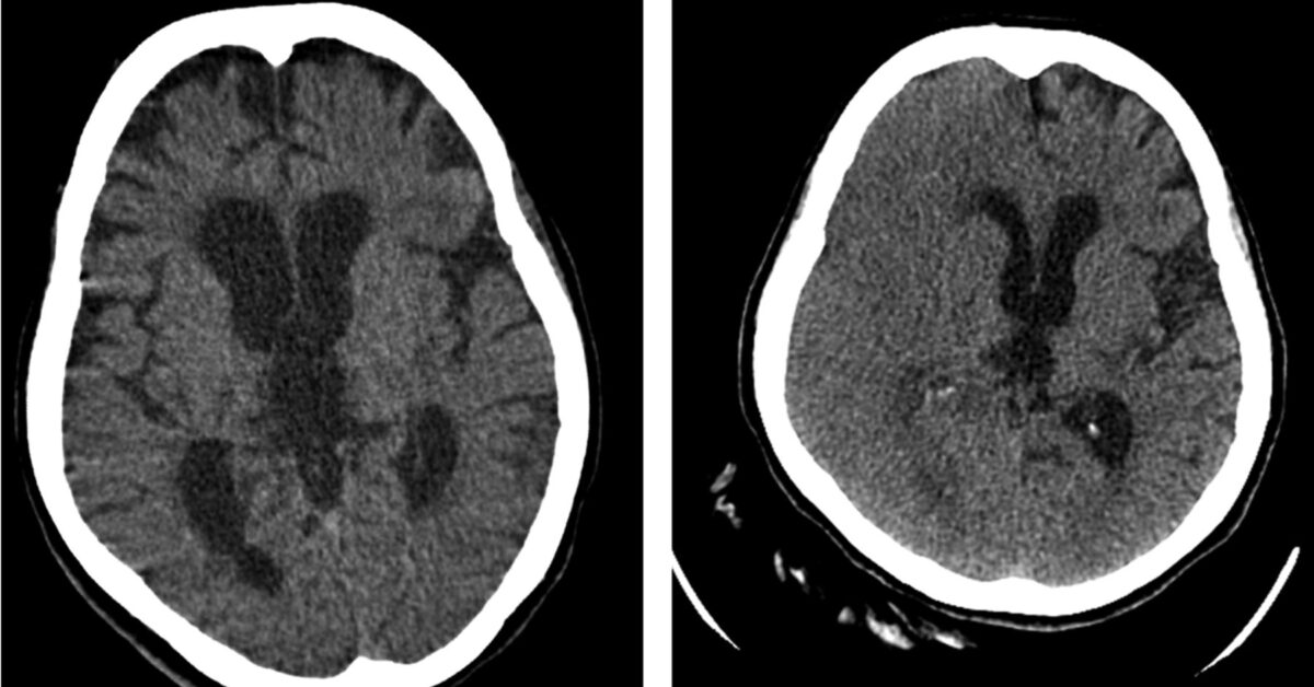 Edema Cerebrale Cosè E Quali Sono Le Cause