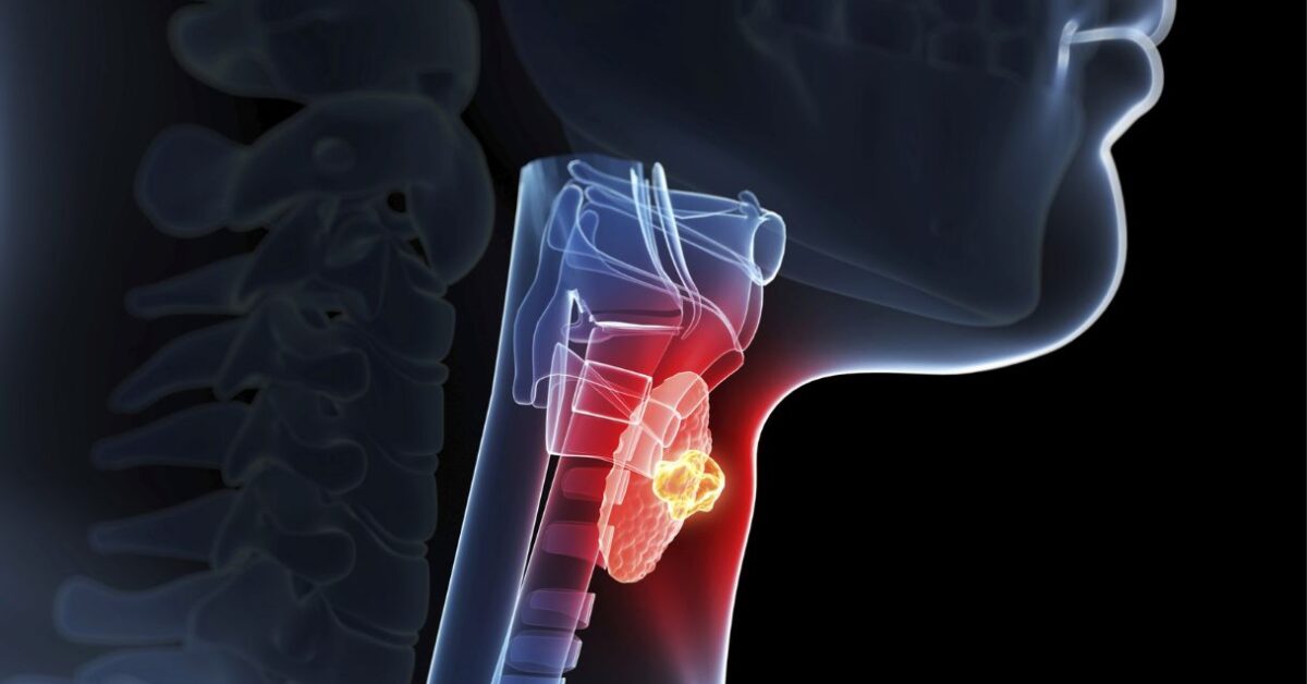 Tiroide ingrossata: cosa mangiare? I consigli