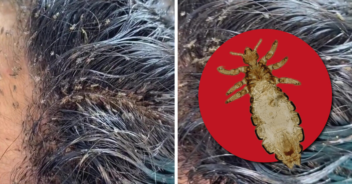 Pidocchi, quali rimedi della nonna? I migliori