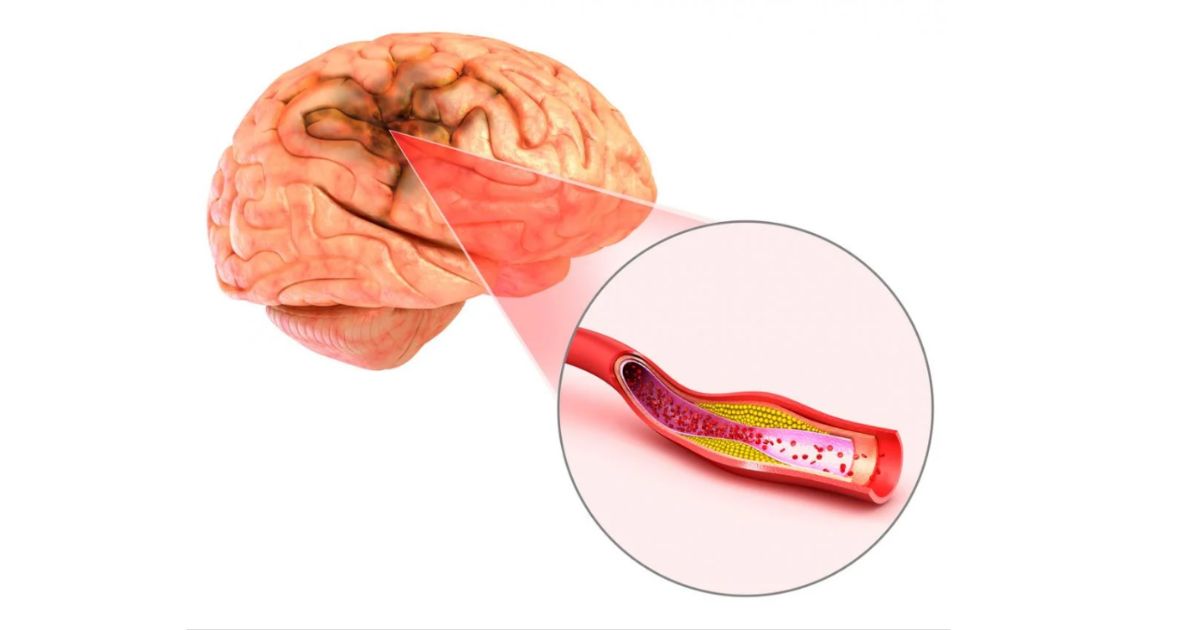 Proctite, cosa devi sapere: sintomi e come eliminarla