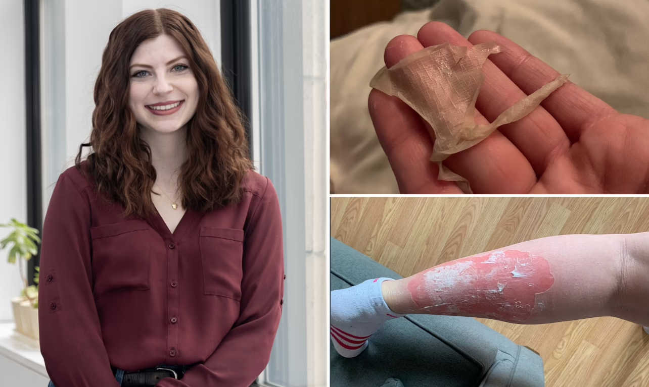 Questa ragazza soffre di una malattia che le fa perdere la pelle come ...