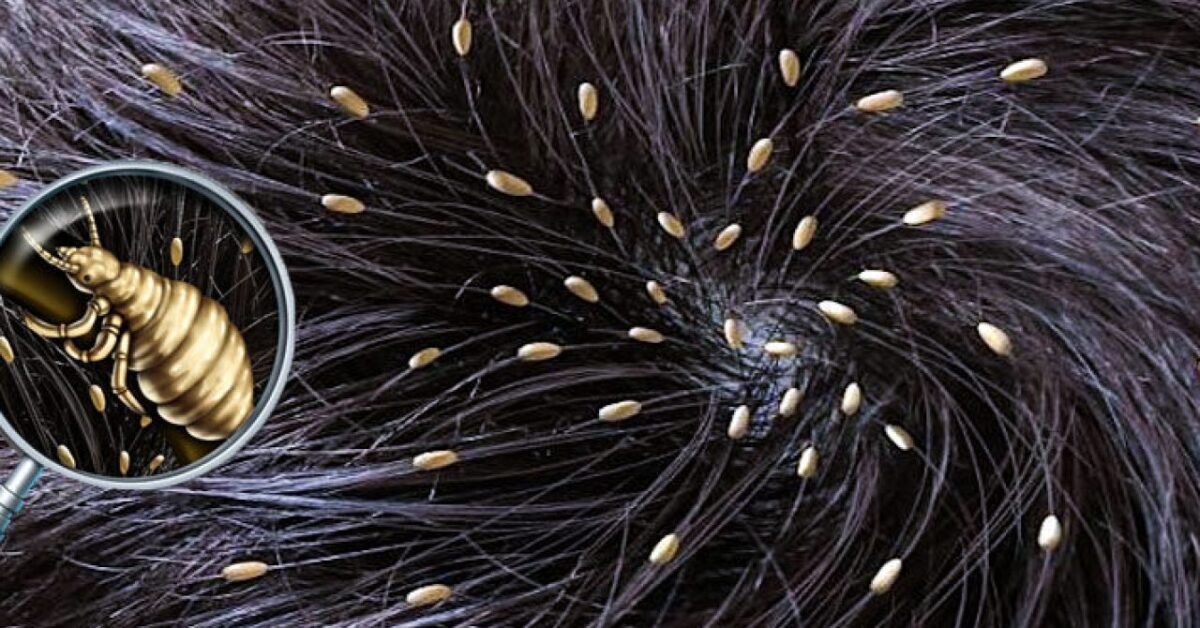 Pidocchi? Nessun problema! Come eliminarli senza tagliare i capelli