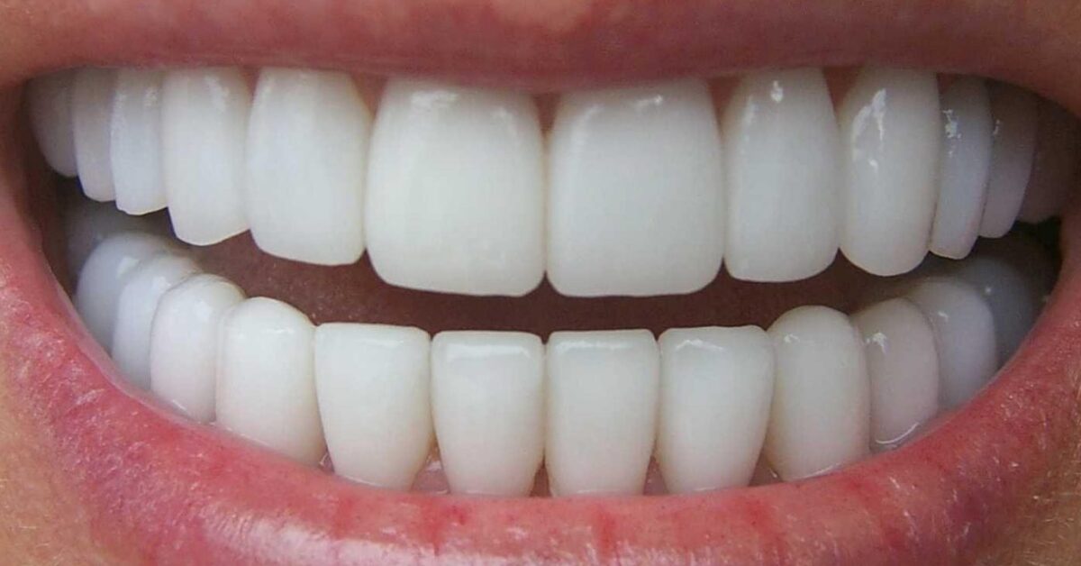 Quali sono gli alimenti che sbiancano i denti? La lista