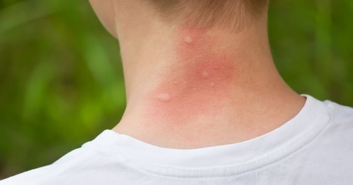 Sindrome di Skeeter: cos'è, sintomi e trattamenti