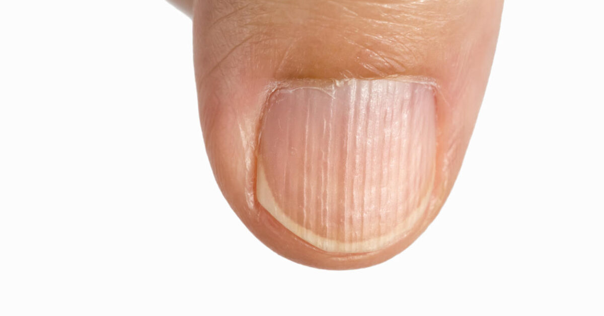 Unghie striate: cosa vogliono dirti davvero