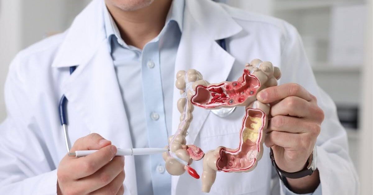 Calprotectina fecale: come leggere i valori e capire se è alta